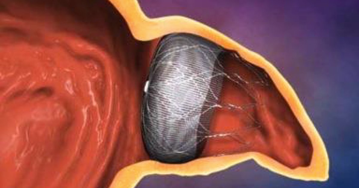 Wann ist ein Herzohr-Verschluss sinnvoll? | cardioaktiv.at
